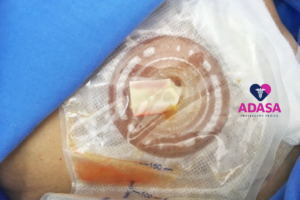 Drenajes quirúrgicos y reservorios: Qué debes saber - Proveedora Medica ...